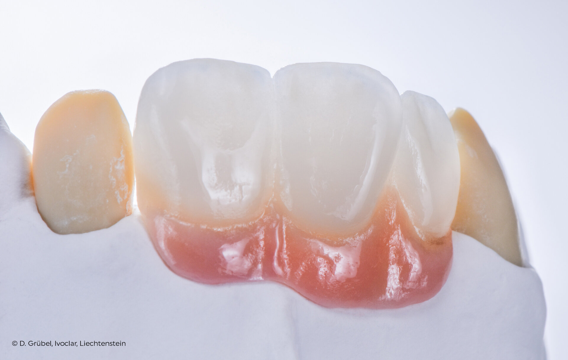 Ips E Max Ceram Dental Veneering Material Ivoclar